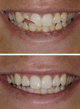 Direct Composite Bonding | Snow Dental Care